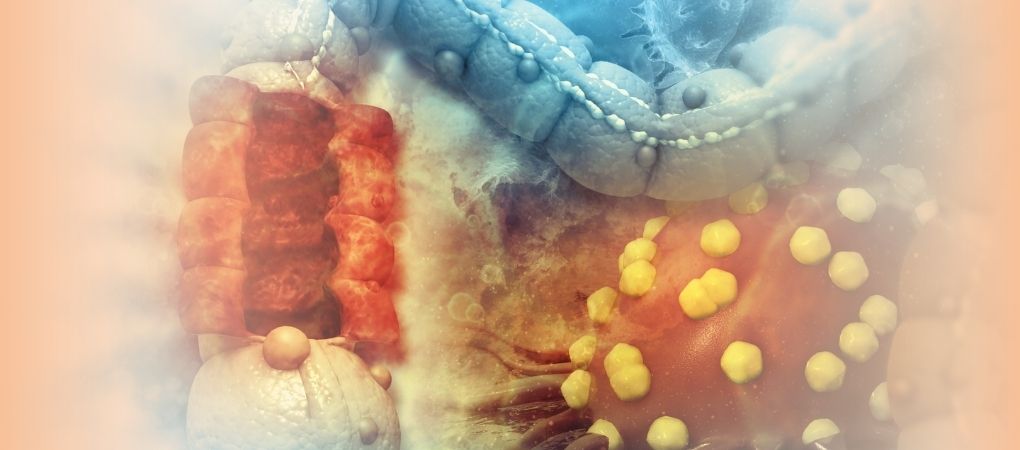 Cancro al colon-retto - Osteopedia - il portale mondiale dell'osteopatia