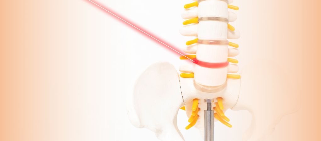 Spondilolistesi istmica - Osteopedia - il portale mondiale dell'osteopatia