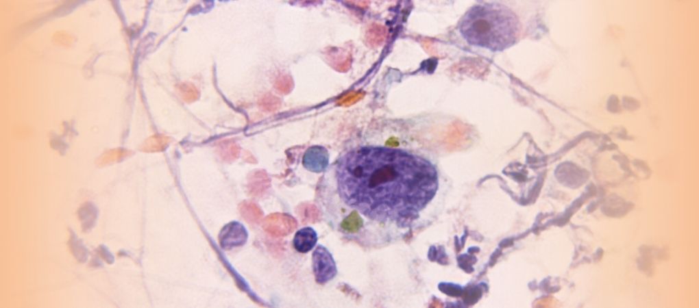 Neoplasie - Osteopedia - il portale mondiale dell'osteopatia